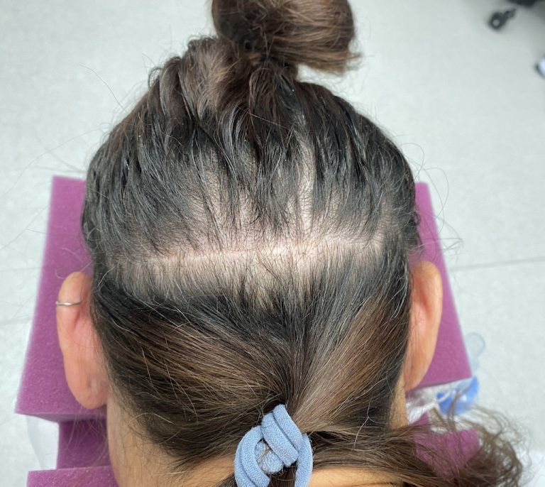 Plastic Surgery Case Study - 1st Stage Scalp Tissue Expander Placement ...