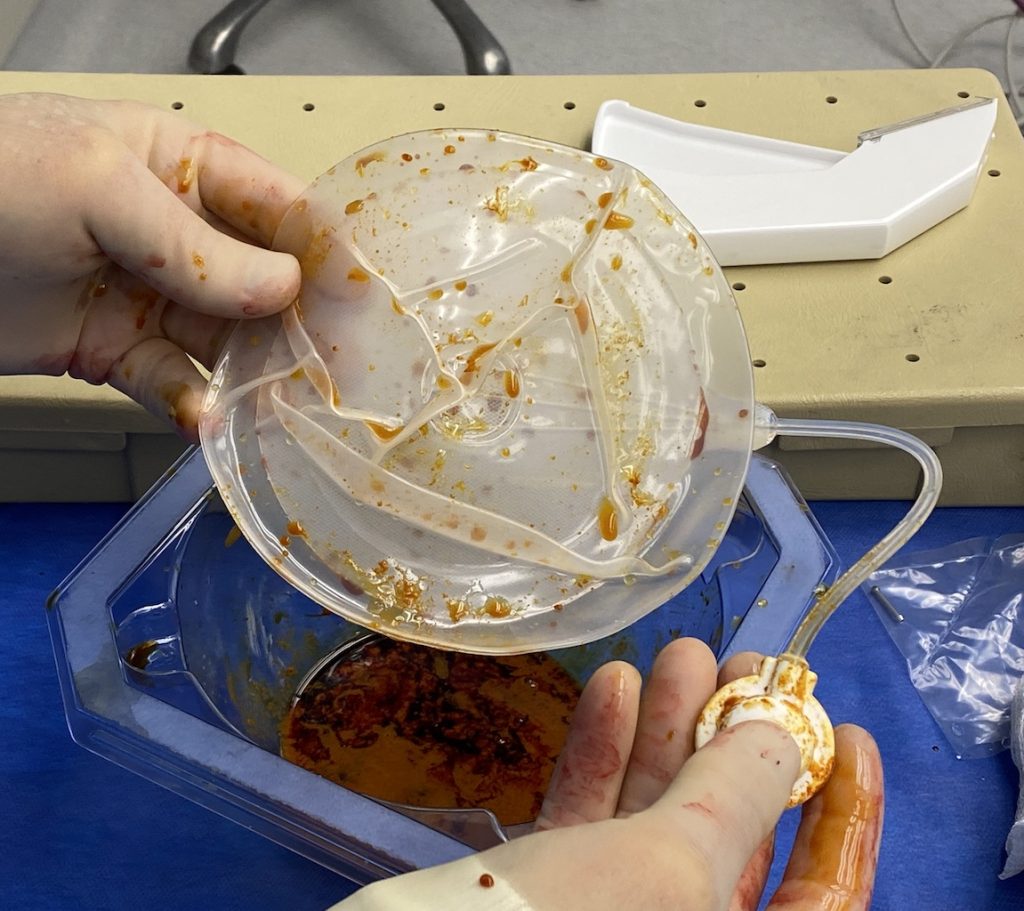 Plastic Surgery Case Study - 1st Stage Scalp Tissue Expander Placement ...