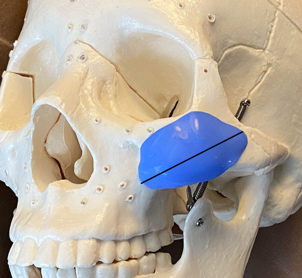Understanding the Anatomic Basis of the High Cheekbone Implant ...