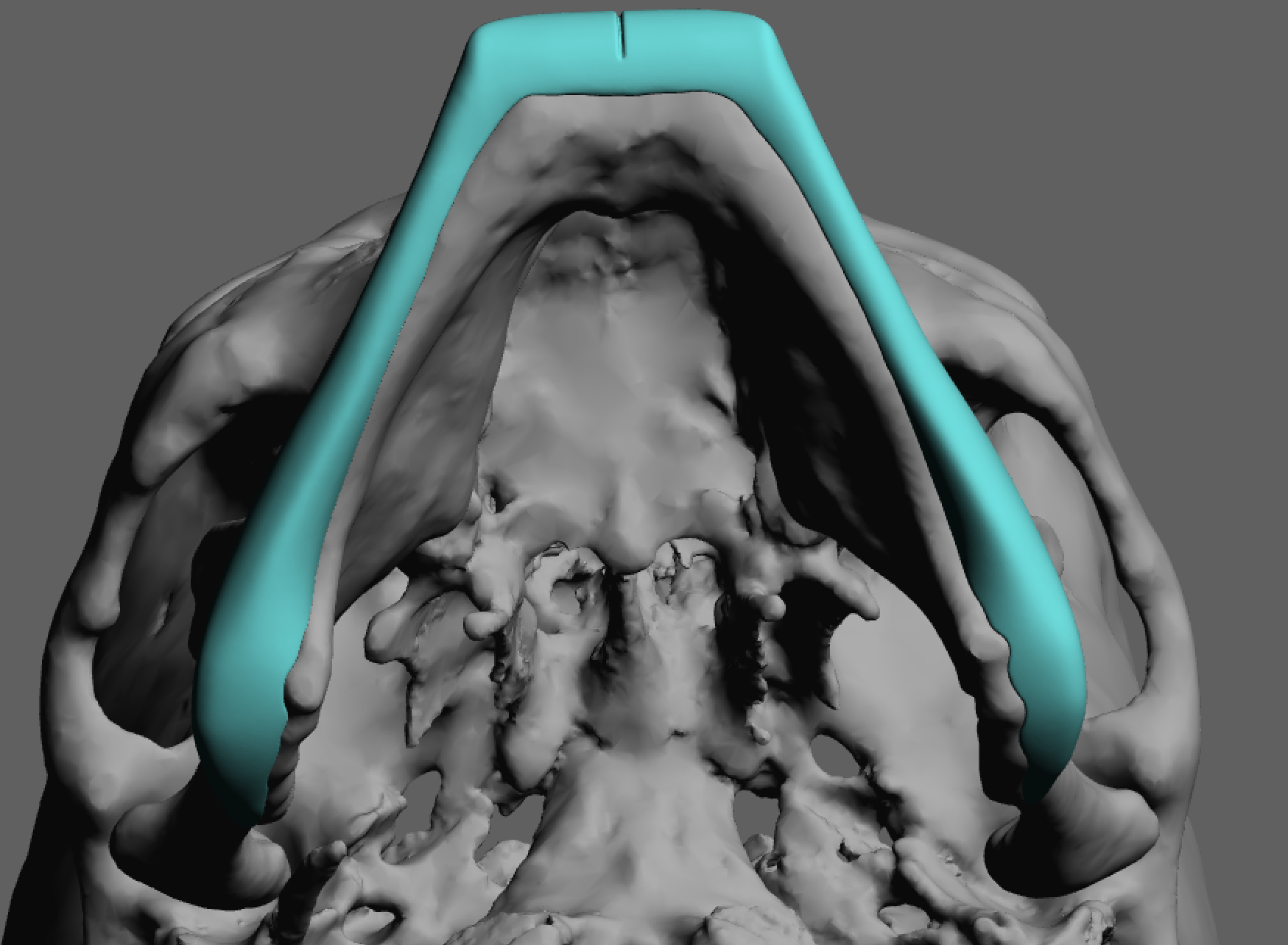 submental view of ligamentous attachments of jaw angles 3D CT scan Dr ...