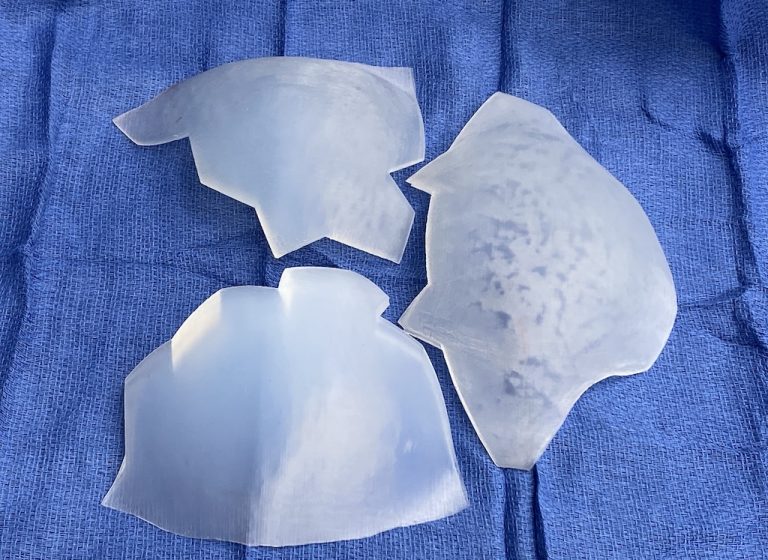 Plastic Surgery Case Study - Two Stage Aesthetic Skull Augmentation ...