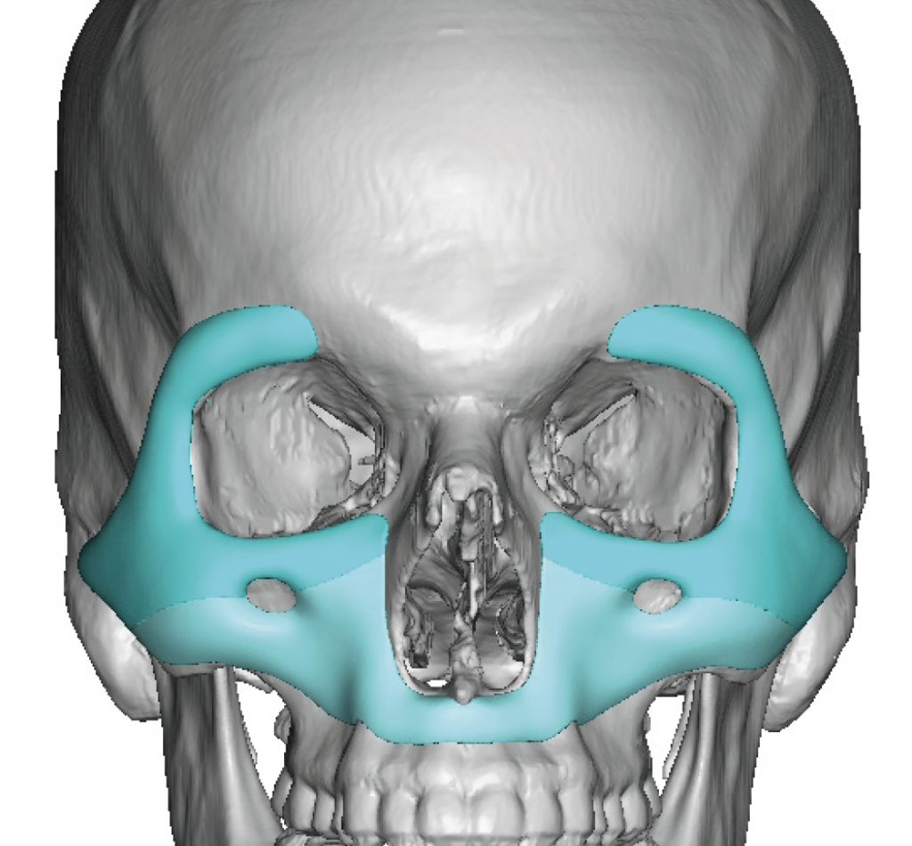 Custom midface implant design front view Dr Barry Eppley - Explore ...