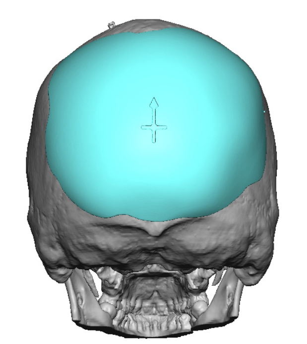 custom back of head skull implant design back view Dr Barry Eppley ...