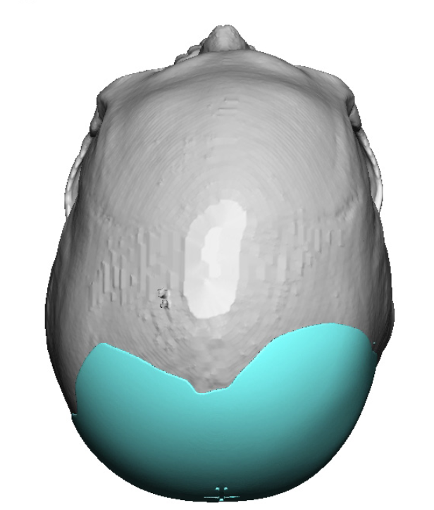 custom back of head skull implant design top view Dr Barry Eppley ...