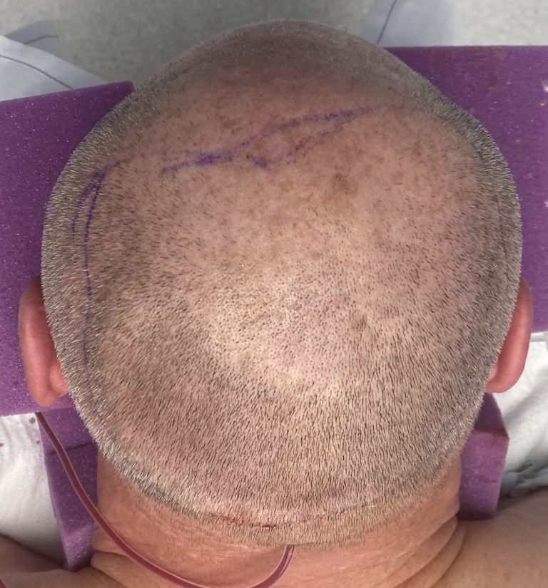 Plastic Surgery Case Study - Male Back of the Head Contouring with a ...