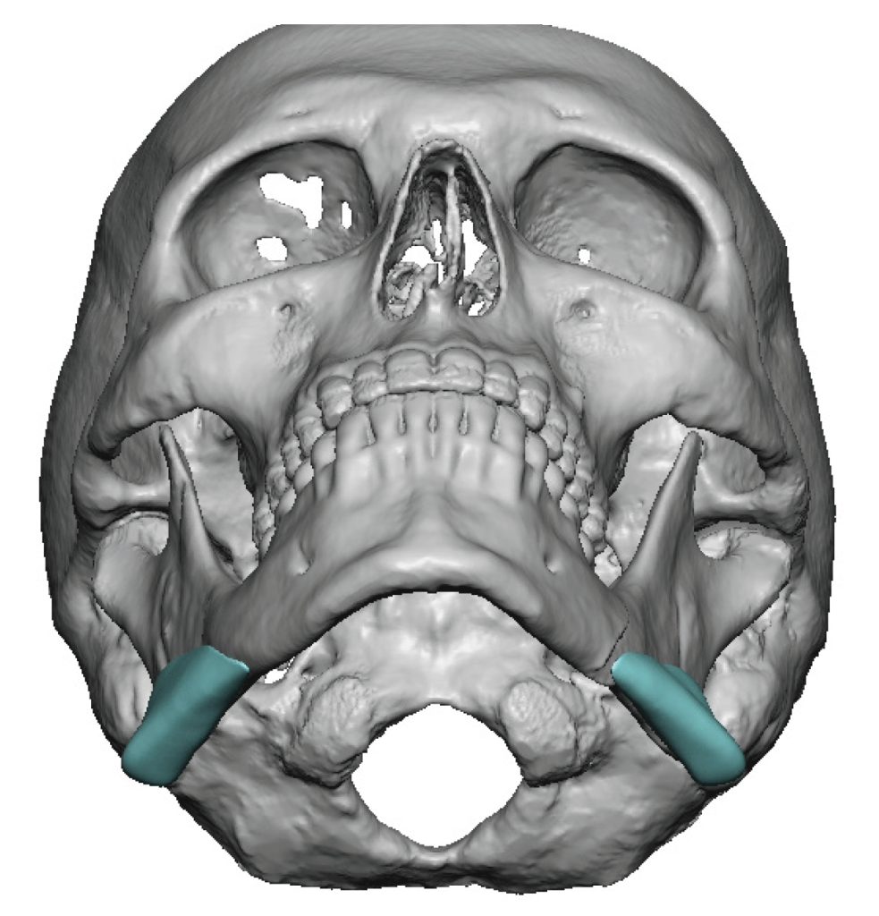 Plastic Surgery Case Study - Custom Jaw Angle Implant Replacements for ...