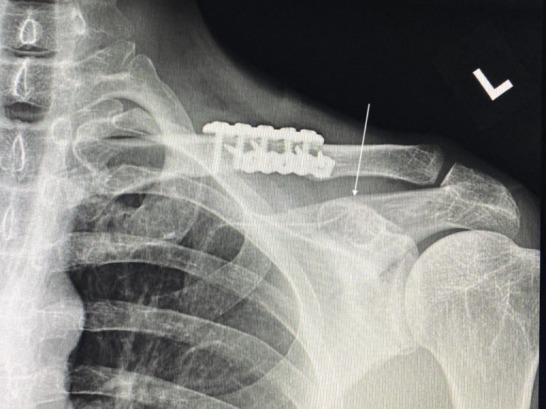 Plastic Surgery Case Study - Shoulder Narrowing Osteotomies Combined ...