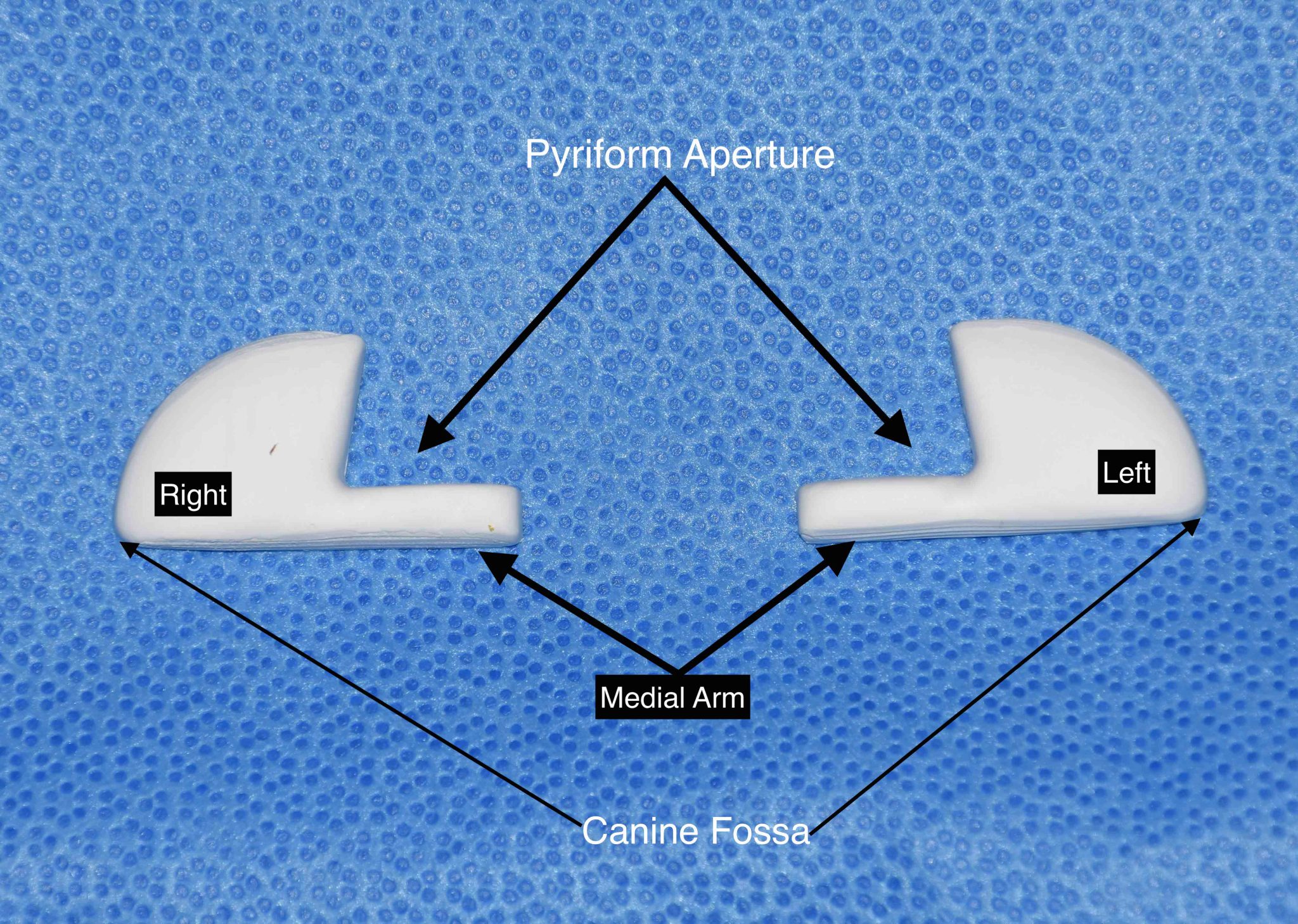 The Aesthetic Projection Created by ePTFE Paranasal Implants - Explore ...