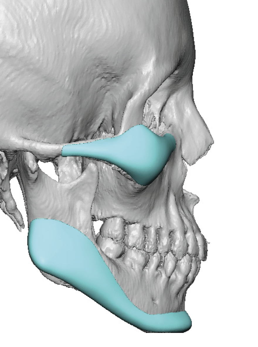 Plastic Surgery Case Study - Female Facial Feminization with Custom ...