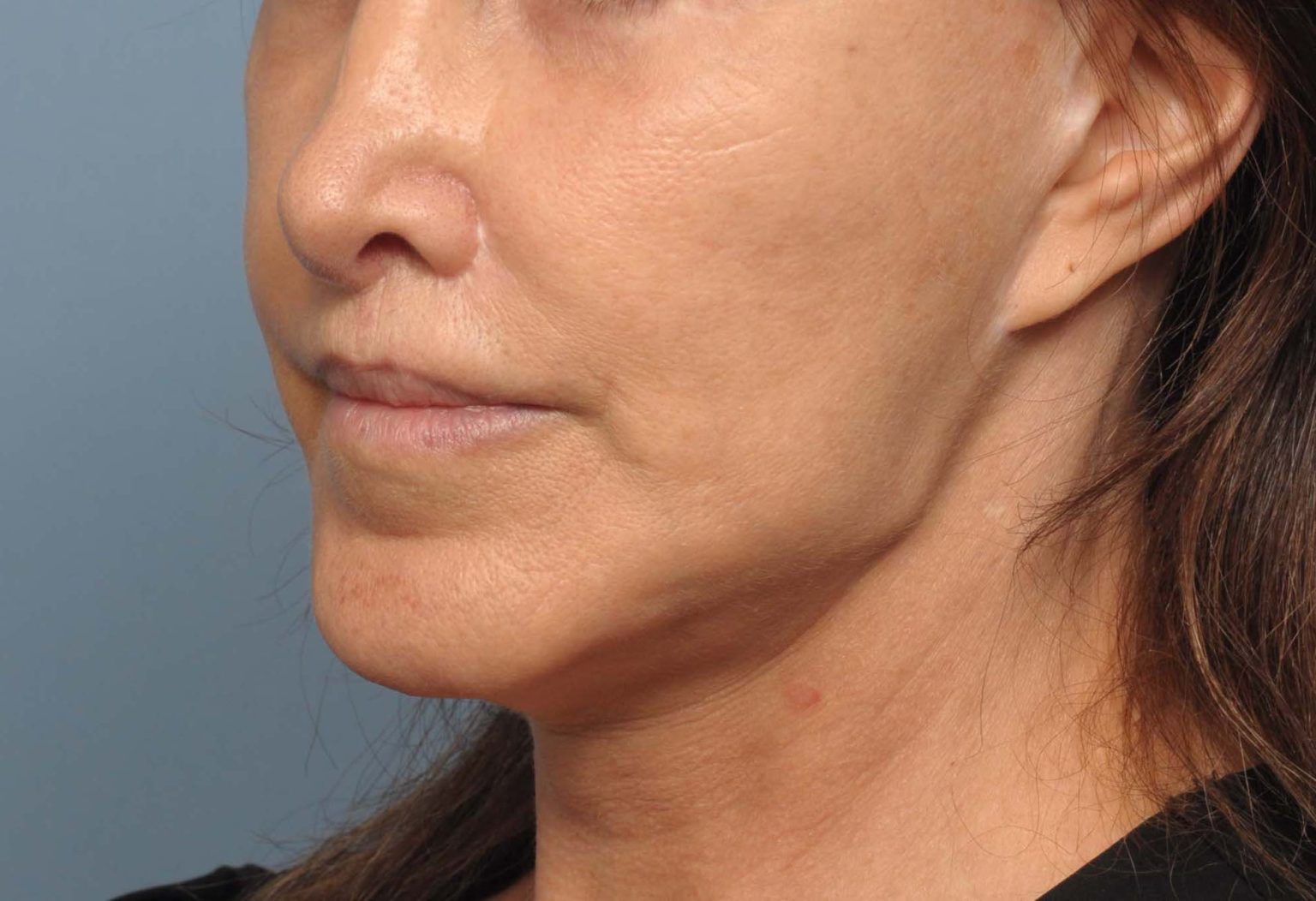 Plastic Surgery Case Study - Female Facial Feminization with Custom ...