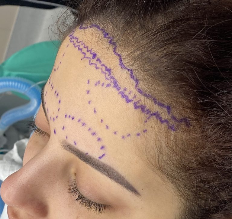 Plastic Surgery Case Study - Total Female Forehead Reshaping with ...