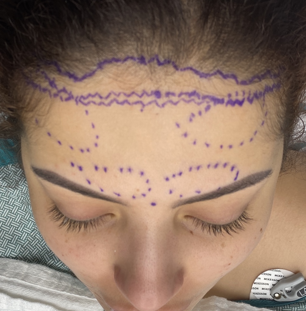 female forejhead reshaping top 1 Dr Barry Eppley - Explore Plastic Surgery