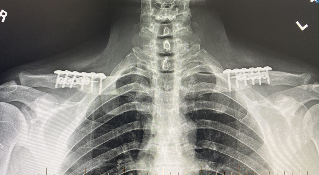 female large shoulder reduction postop x-ray Dr Barry Eppley - Explore ...