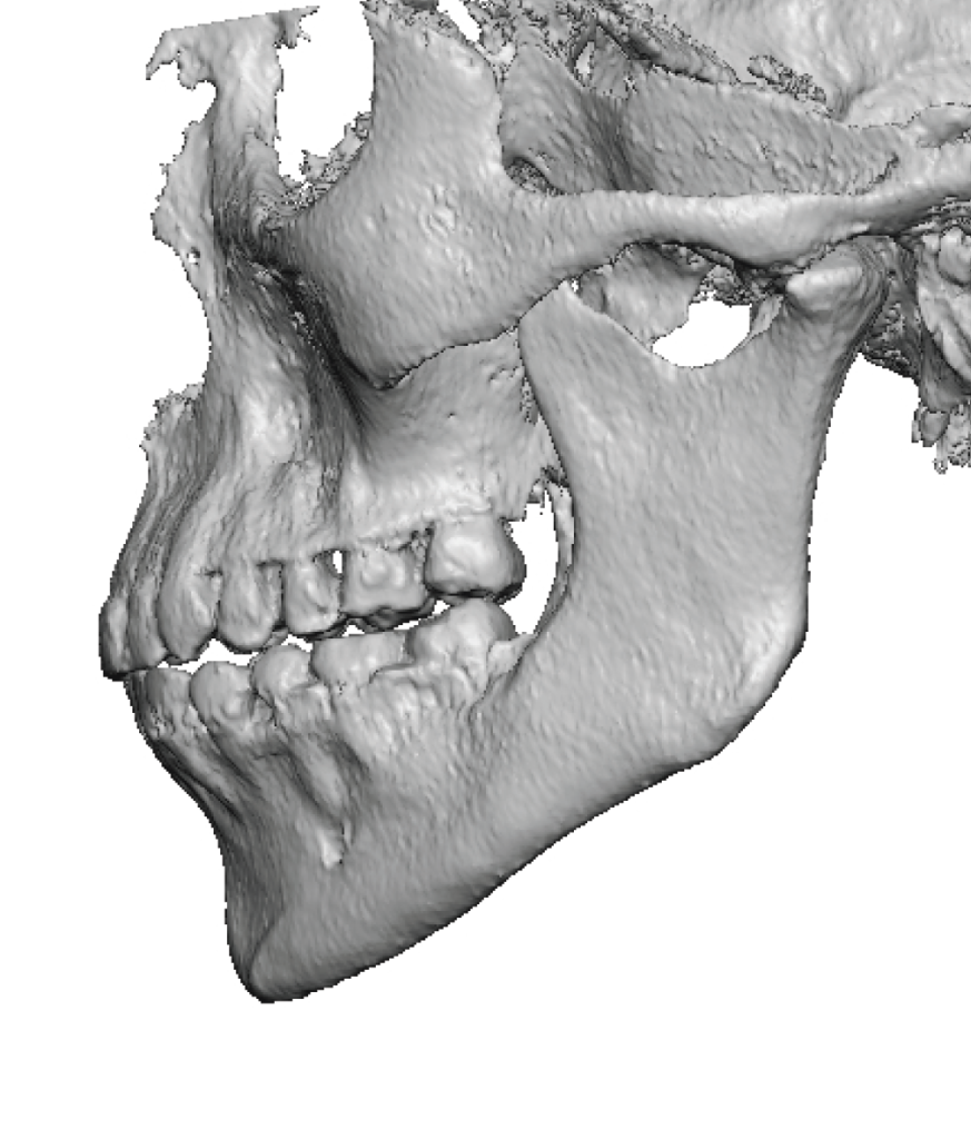 Plastic Surgery Case Study - Ligamentous Muscle Releases in Custom ...