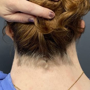 webbed neck surgery Archives - Explore Plastic Surgery