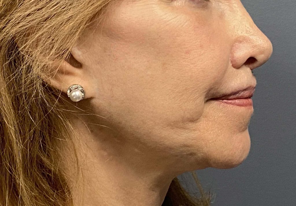 Plastic Surgery Case Study - Female Facial Feminization with Custom ...