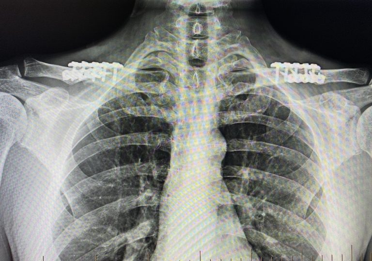 Plastic Surgery Case Study - Shoulder Narrowing Osteotomies Combined ...