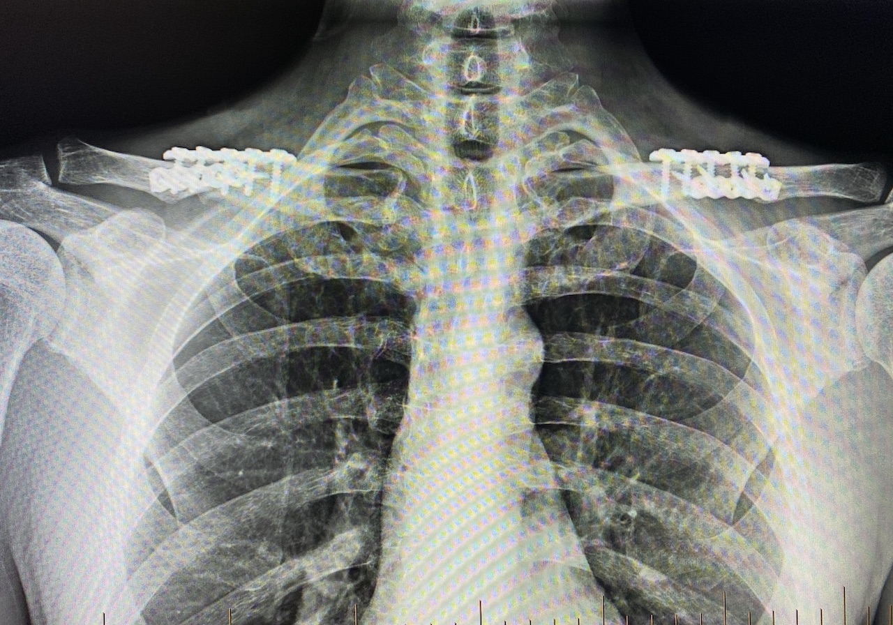 Plastic Surgery Case Study - Shoulder Narrowing Osteotomies Combined ...