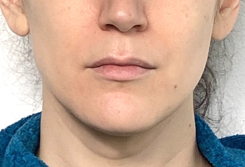 female v line surgery front 1 Dr Barry Eppley - Explore Plastic Surgery