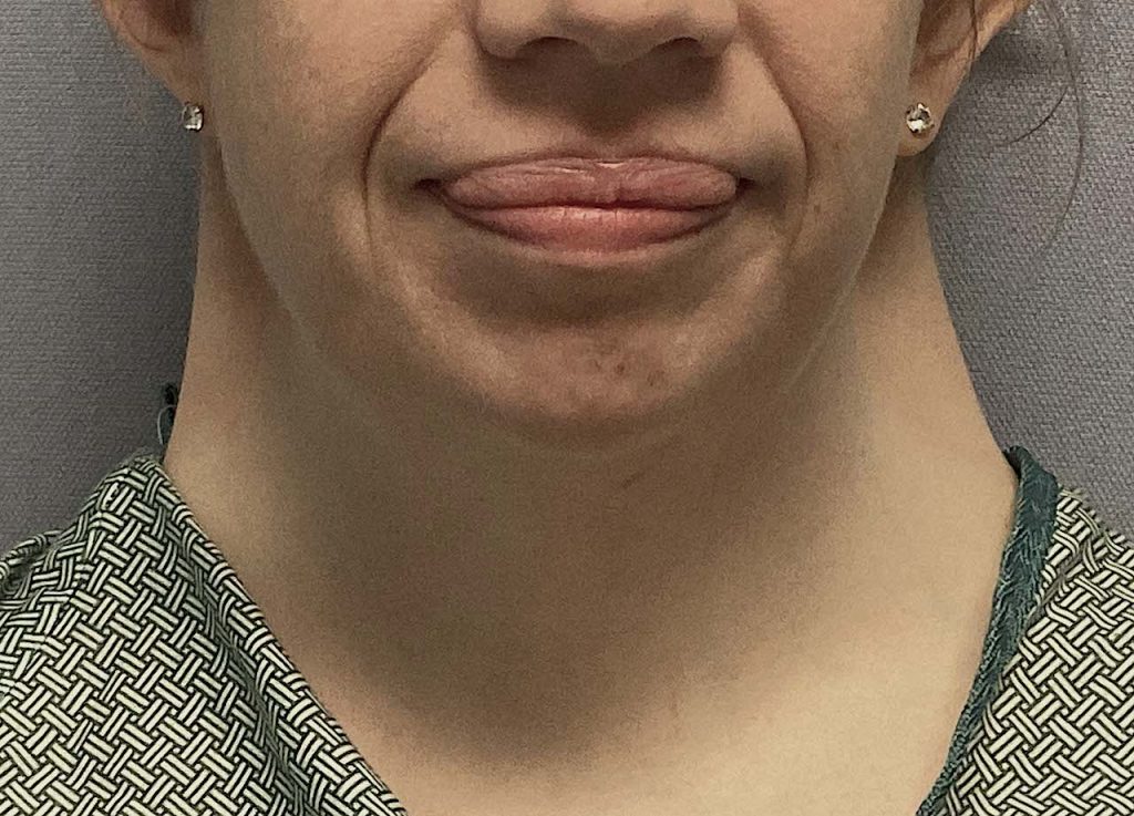 female webbed neck front 1a Dr Barry Eppley - Explore Plastic Surgery