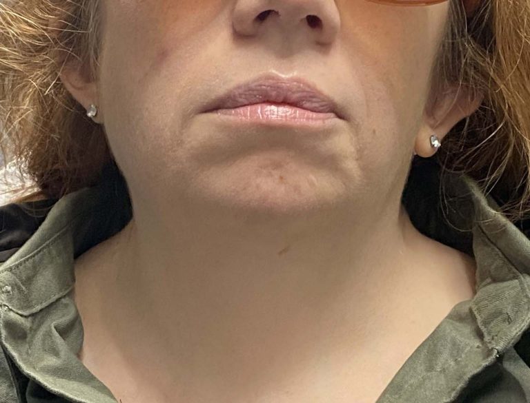 Plastic Surgery Case Study - The Posterior Translocation Method in ...