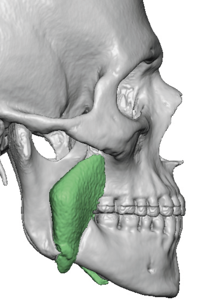 Plastic Surgery Case Study - Custom Jaw Angle Implant Replacements for ...