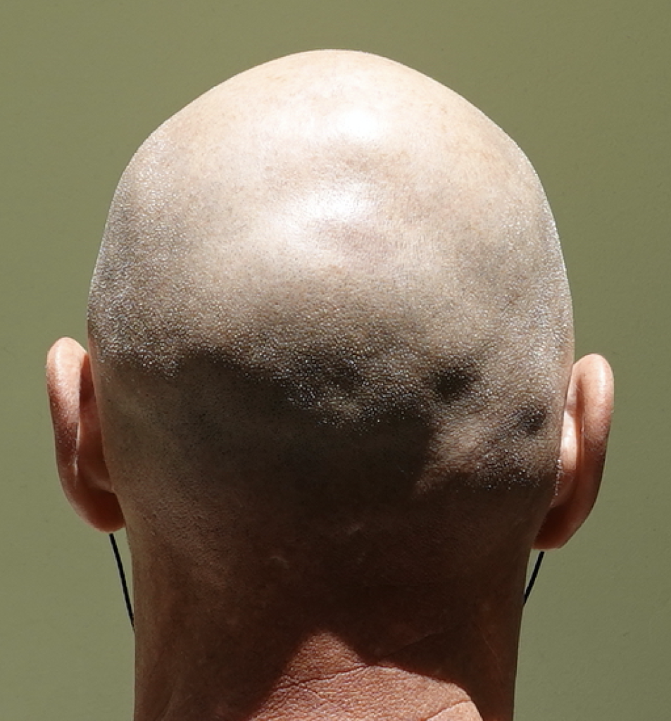 Plastic Surgery Case Study - Male Back of the Head Contouring with a ...