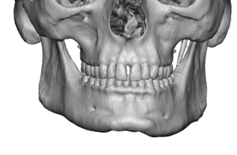 male bony jaw angle implan anatomy 2 Dr Barry Eppley - Explore Plastic ...
