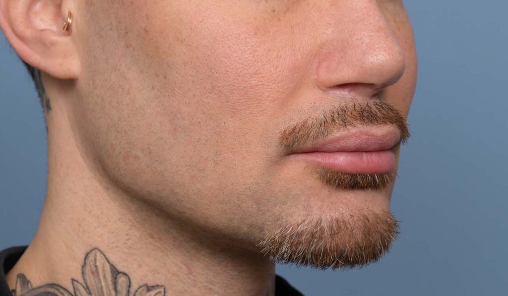 Plastic Surgery Case Study - The Vertical Lengthening Custom Jawline ...