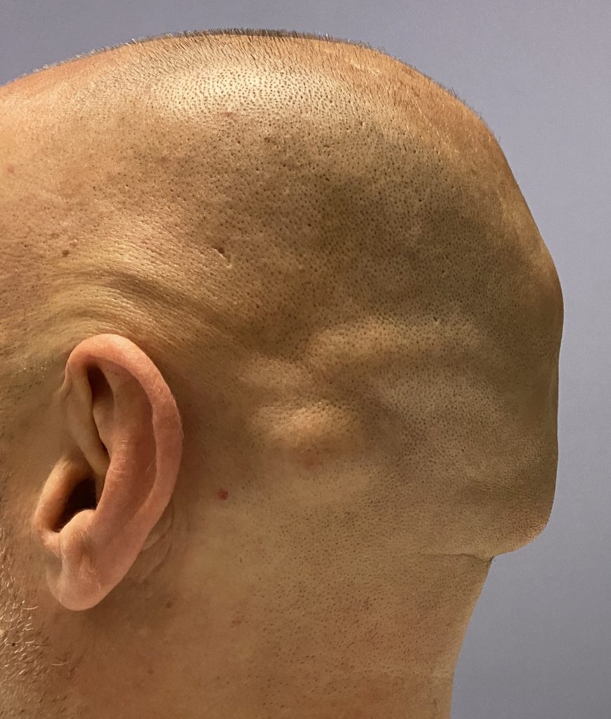 Plastic Surgery Case Study - Back of the Head Combined Bony (Occipital ...