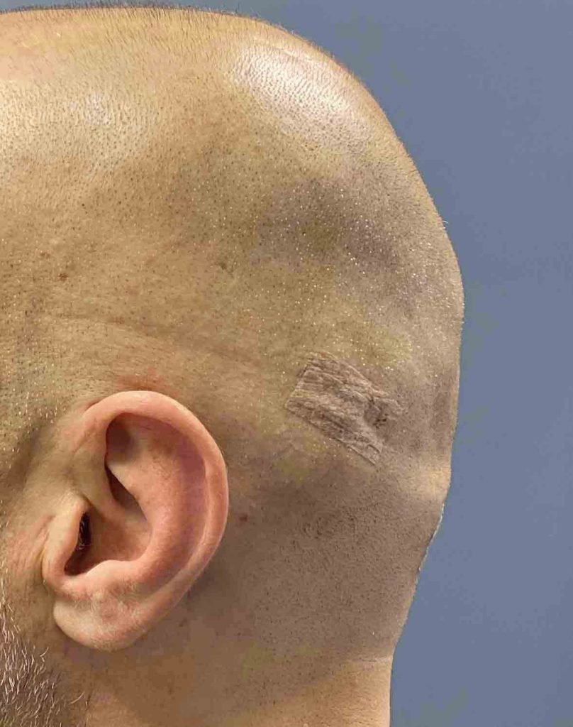 Plastic Surgery Case Study - Back of the Head Combined Bony (Occipital ...