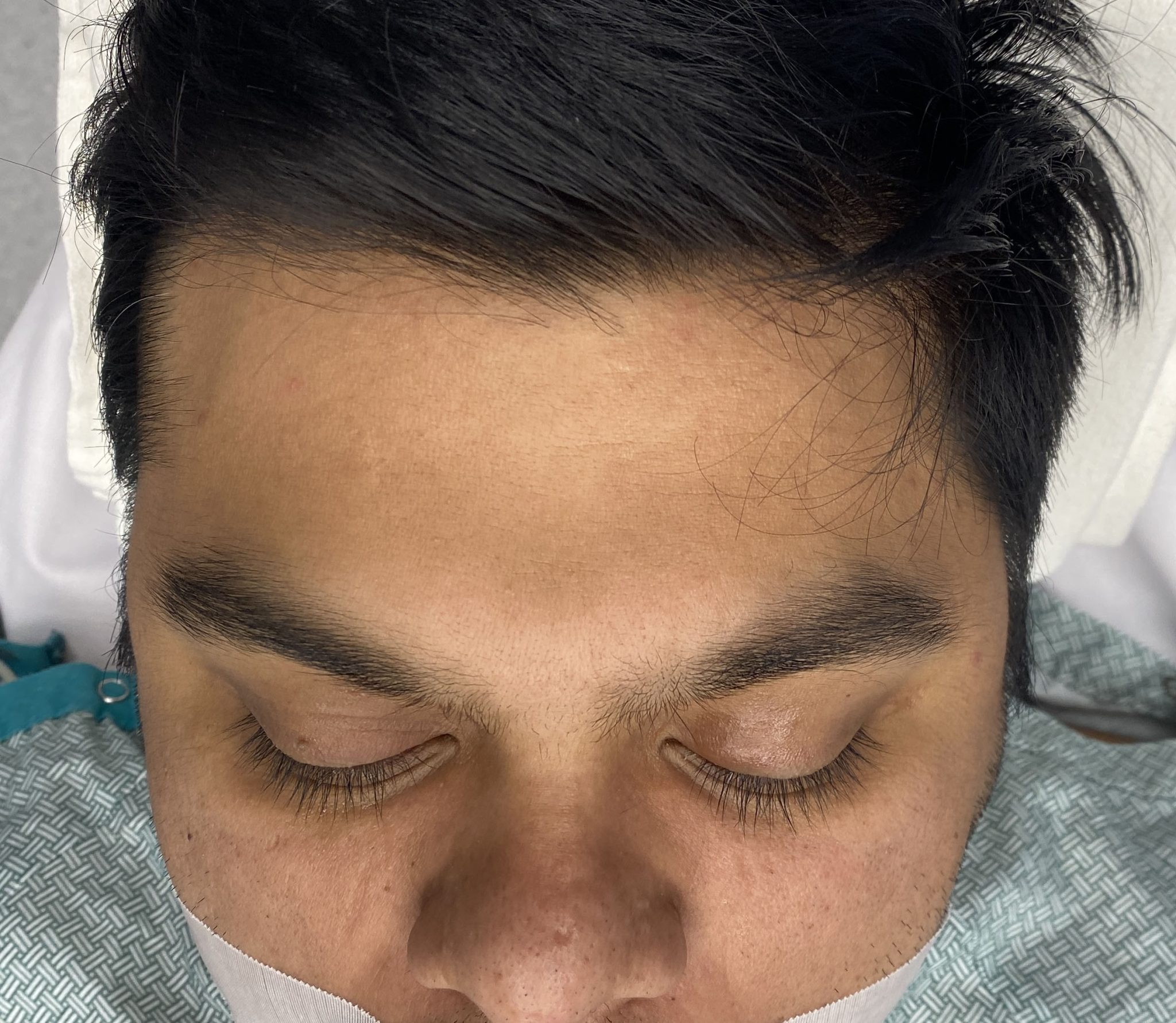 Plastic Surgery Case Study - Forehead Asymmetry Correction with a ...