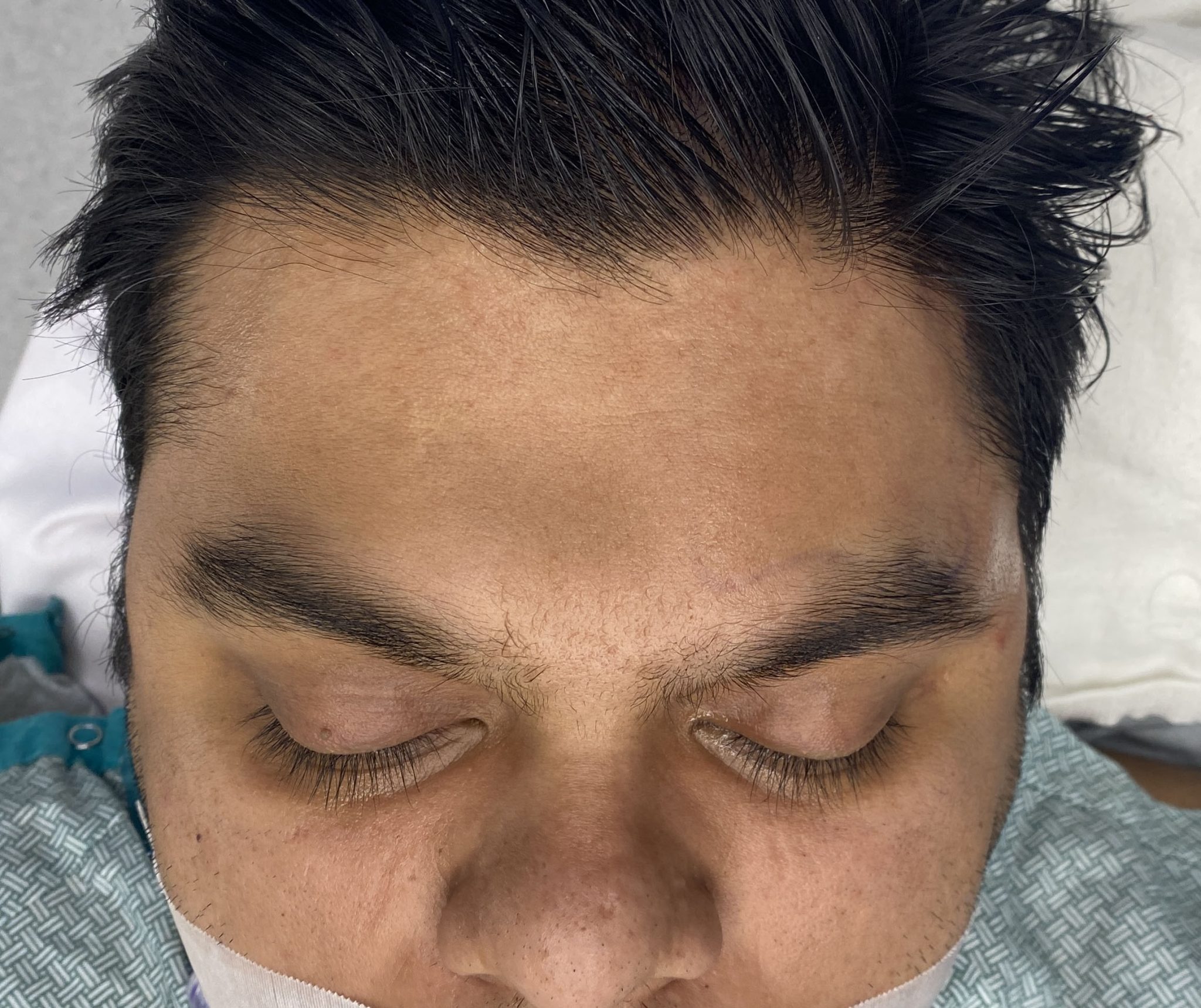 Plastic Surgery Case Study - Forehead Asymmetry Correction with a ...