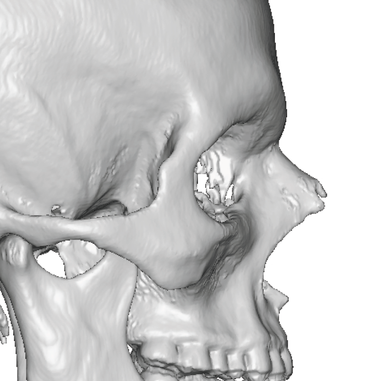 male midface deficiency 3D CT scan side view Dr Barry Eppley - Explore ...