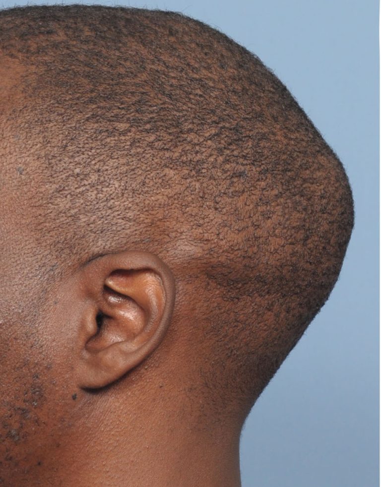 Plastic Surgery Case Study - Secondary Occipital Bone Reduction after ...