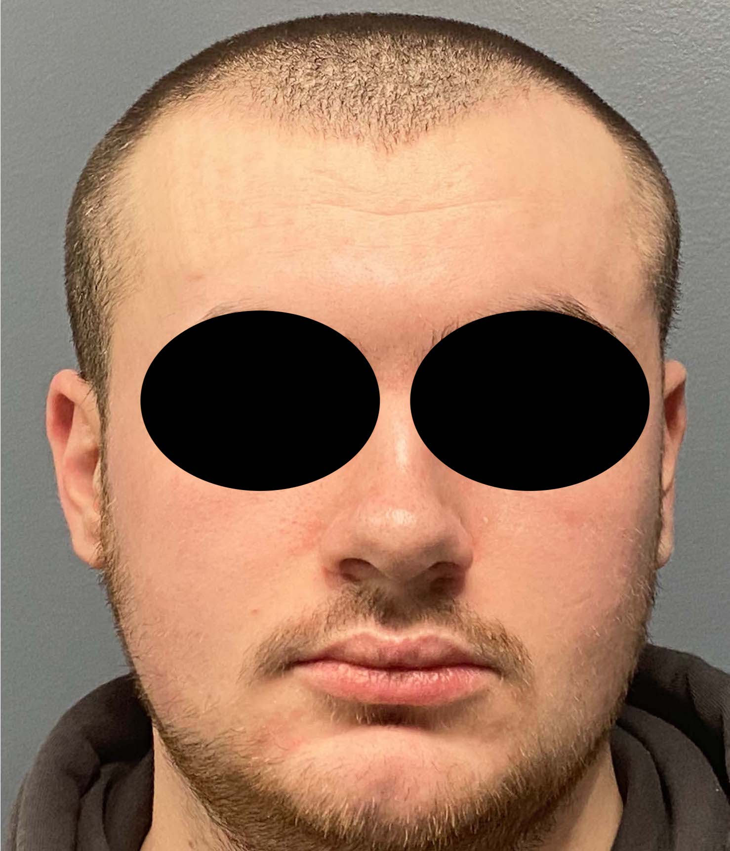 male temporal red front 1 Dr Barry Eppley copy - Explore Plastic Surgery