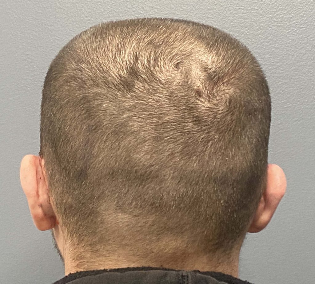 Plastic Surgery Case Study - The Wide Mouth Opening Test in Temporal ...