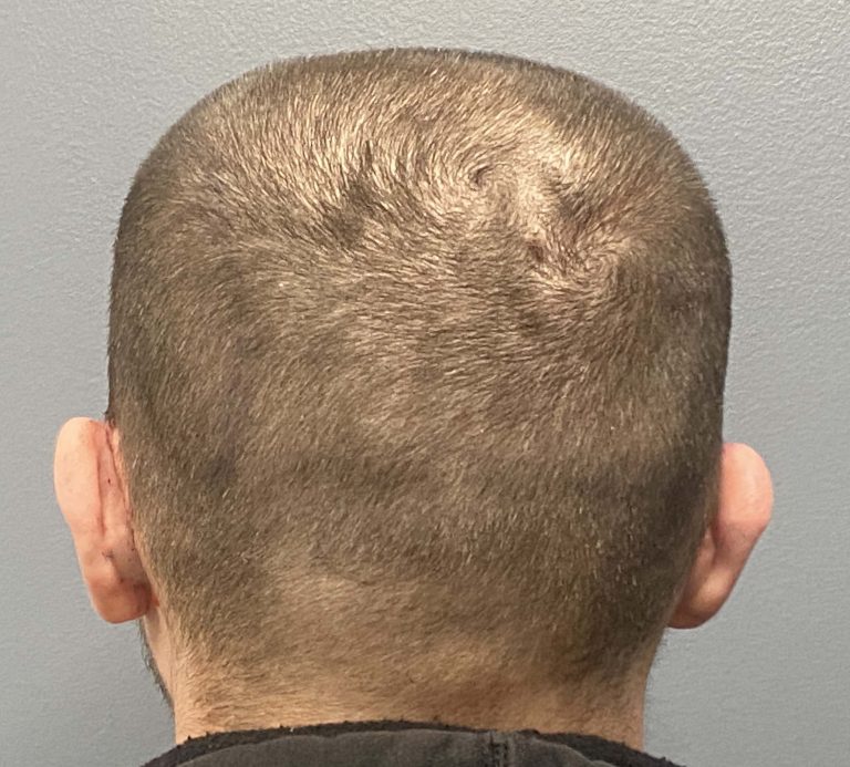 Plastic Surgery Case Study - The Wide Mouth Opening Test in Temporal ...