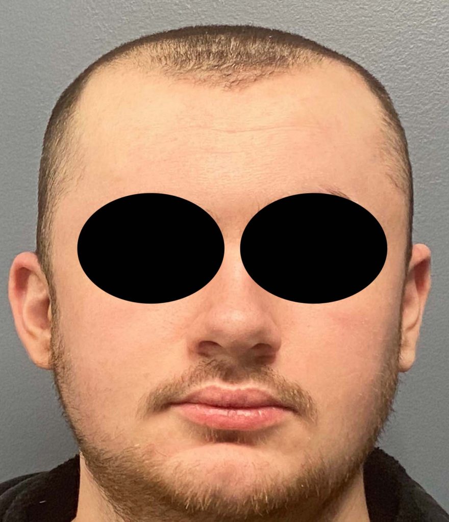 Plastic Surgery Case Study - The Wide Mouth Opening Test in Temporal ...