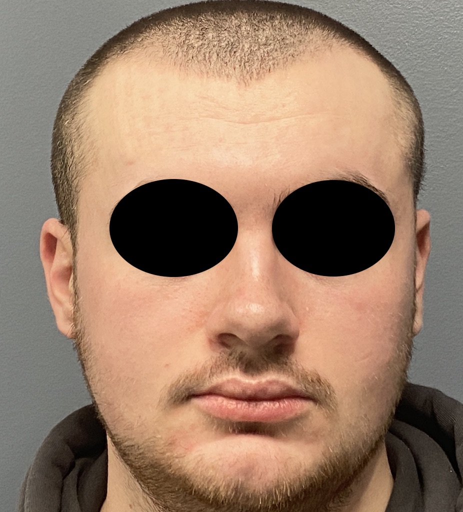 Plastic Surgery Case Study - The Wide Mouth Opening Test in Temporal ...