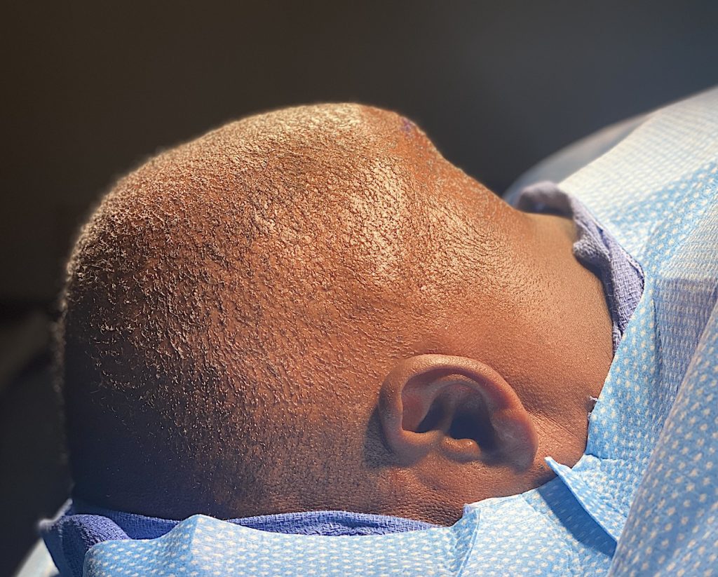 Plastic Surgery Case Study - Secondary Occipital Bone Reduction after ...