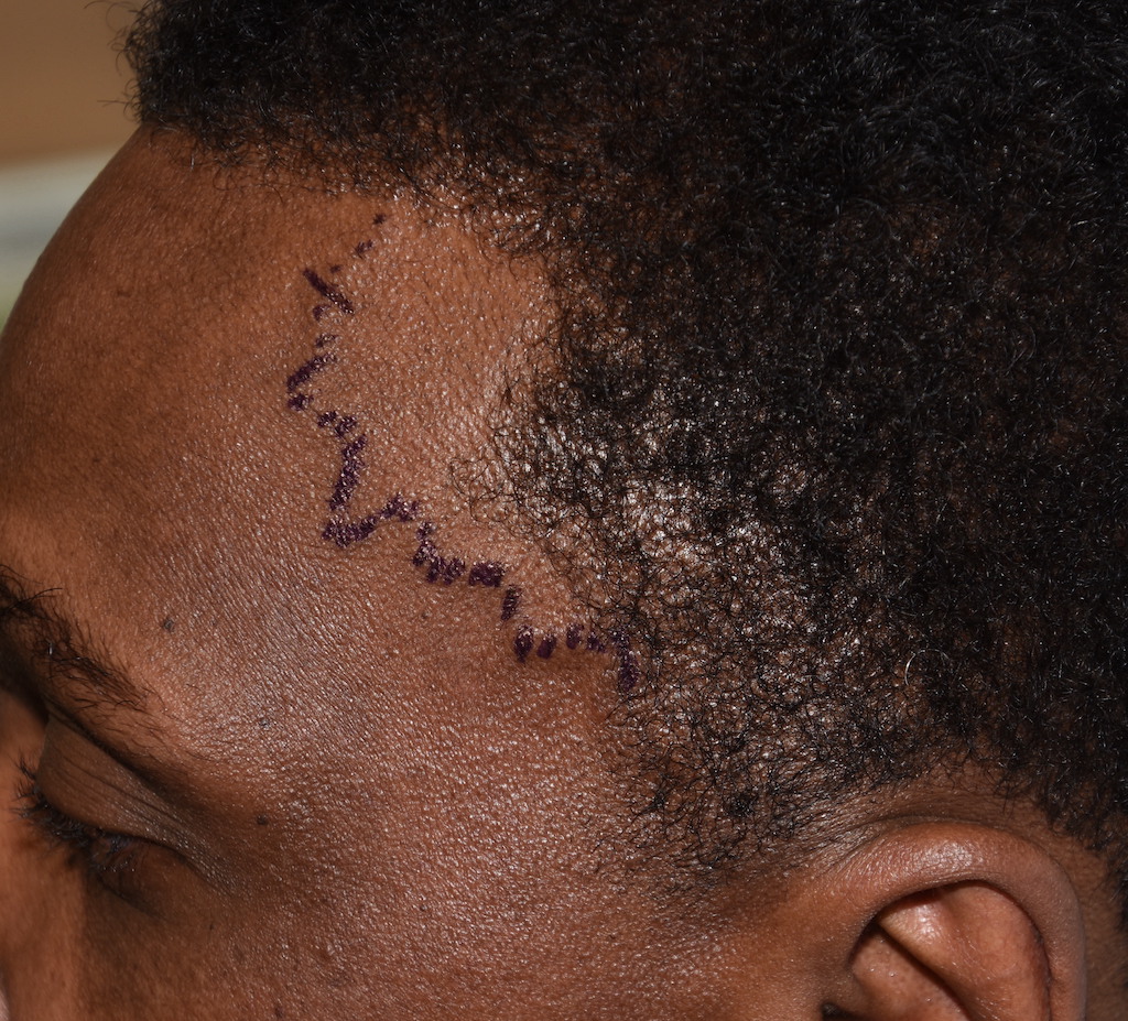 Plastic Surgery Case Study - Multi-Level Ligations of Type 2 Prominent ...