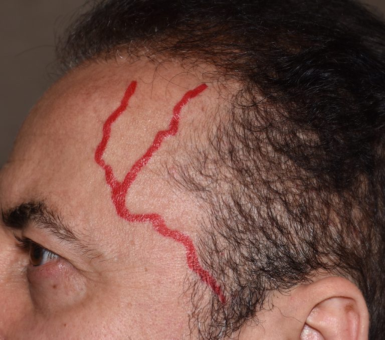 type 2 prominent temporal artery Drt Barry Eppley - Explore Plastic Surgery