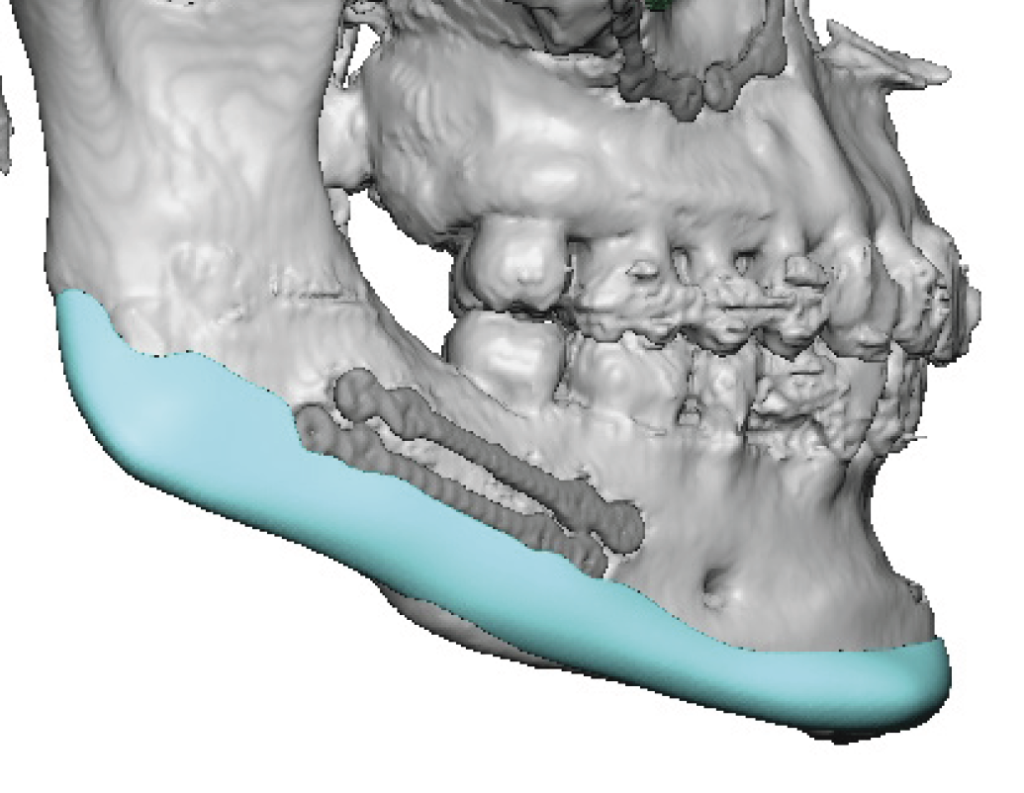 1st custom jawline implant design side view Dr Barry Eppley - Explore ...