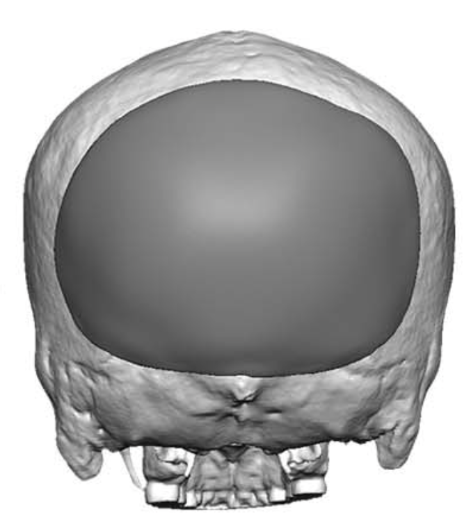 Plastic Surgery Case Study - Long Term Results of Custom HTR Implant ...