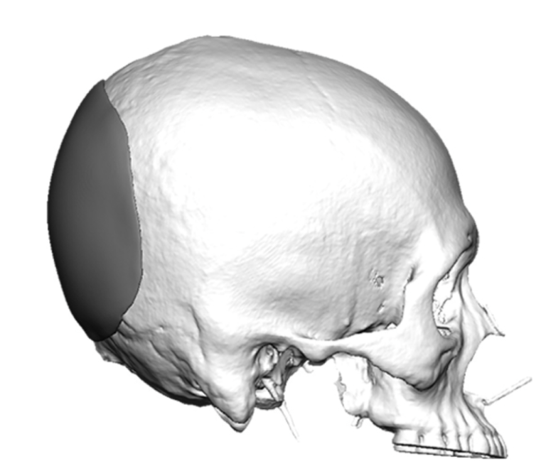 HTR custom back of head skull implant design side view Dr Barry Eppley ...