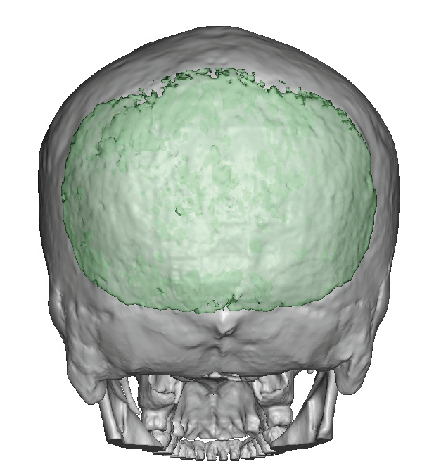HTR custom skull implant postop 3D CT scan back view Dr Barry Eppley ...