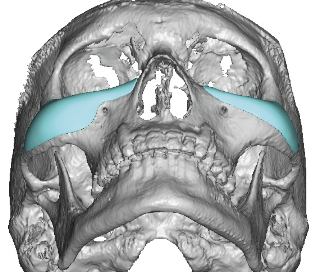 Plastic Surgery Case Study - Custom Infraorbital-Malar Implants for Eye ...