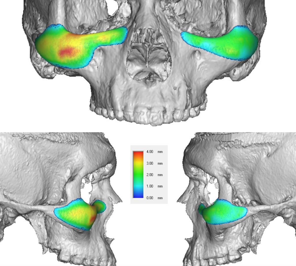 Plastic Surgery Case Study - Custom Infraorbital-Malar Implants for Eye ...