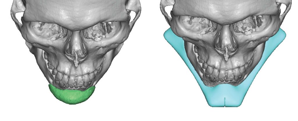 Plastic Surgery Case Study - Chin Implant Replacement with Custom ...